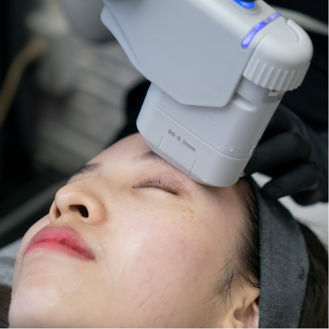 Ultra V-Lift for Body and Face (HIFU)